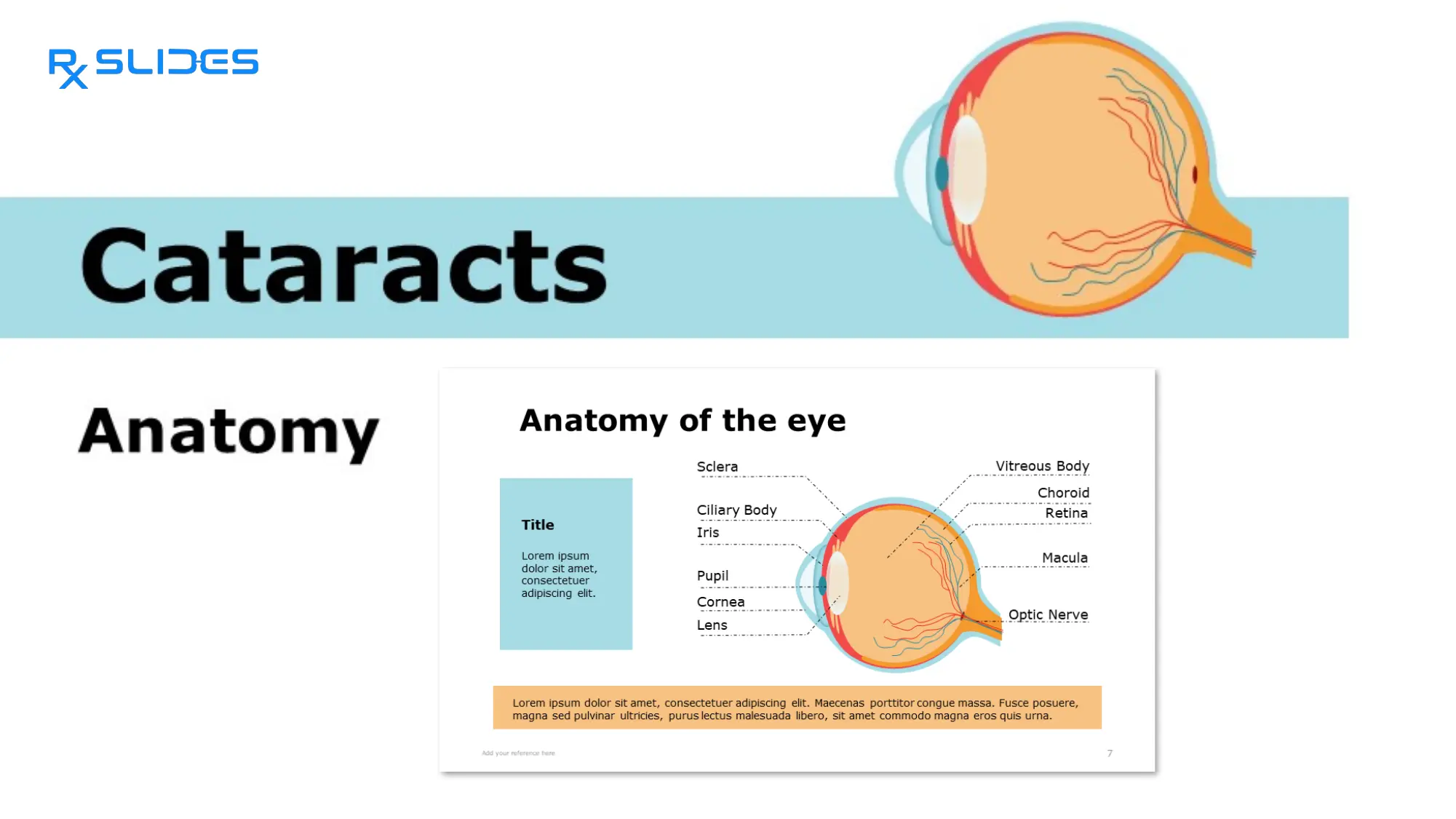 Download Cataracts PowerPoint Template|
