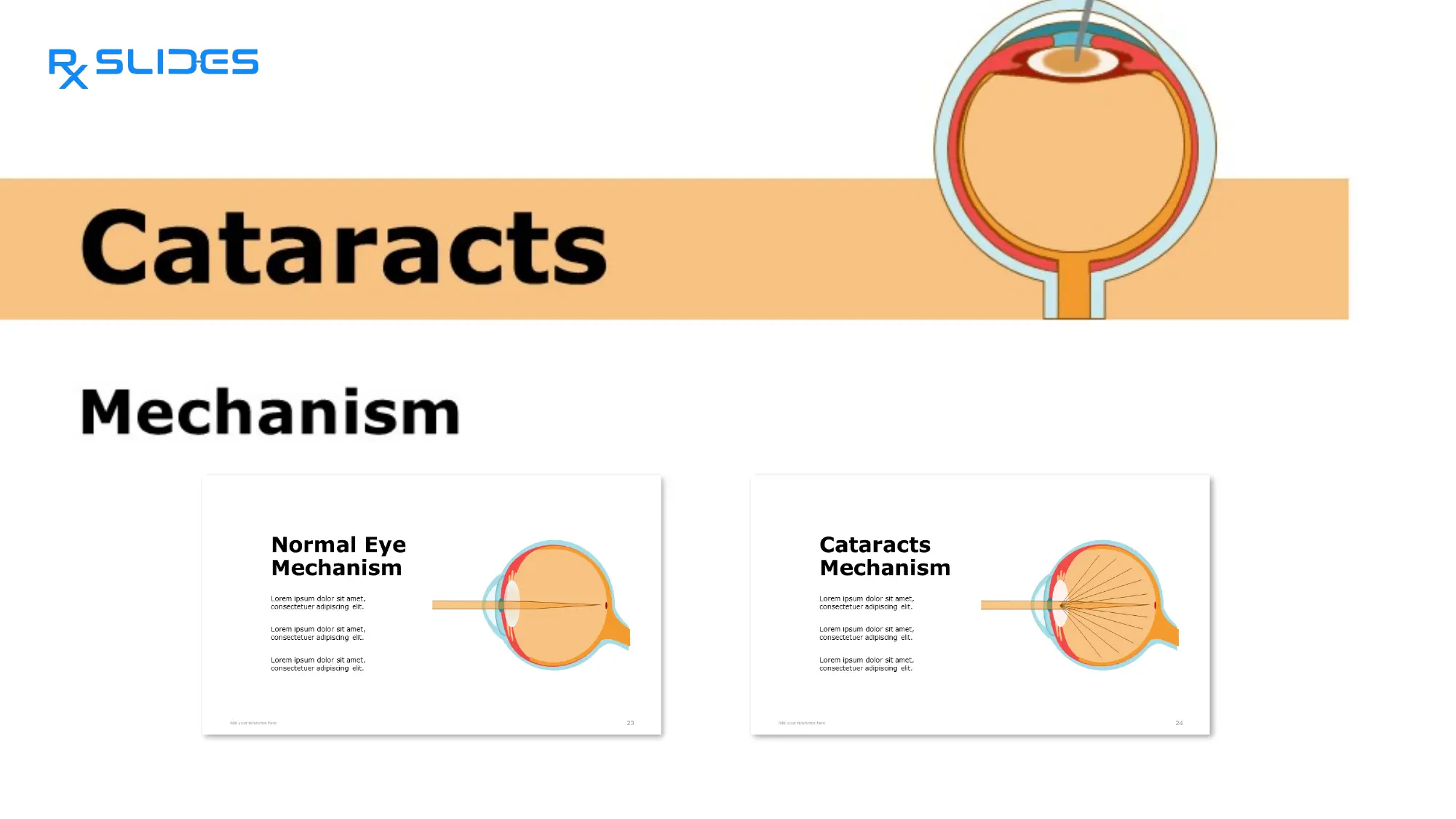 Download Cataracts PowerPoint Template|