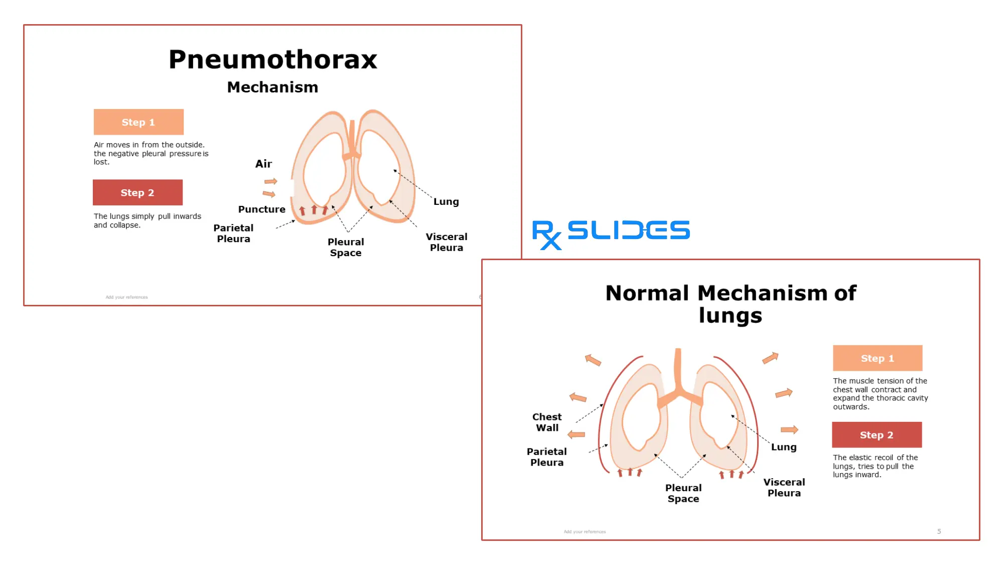 Download Pneumothorax PowerPoint Template| RxSlides