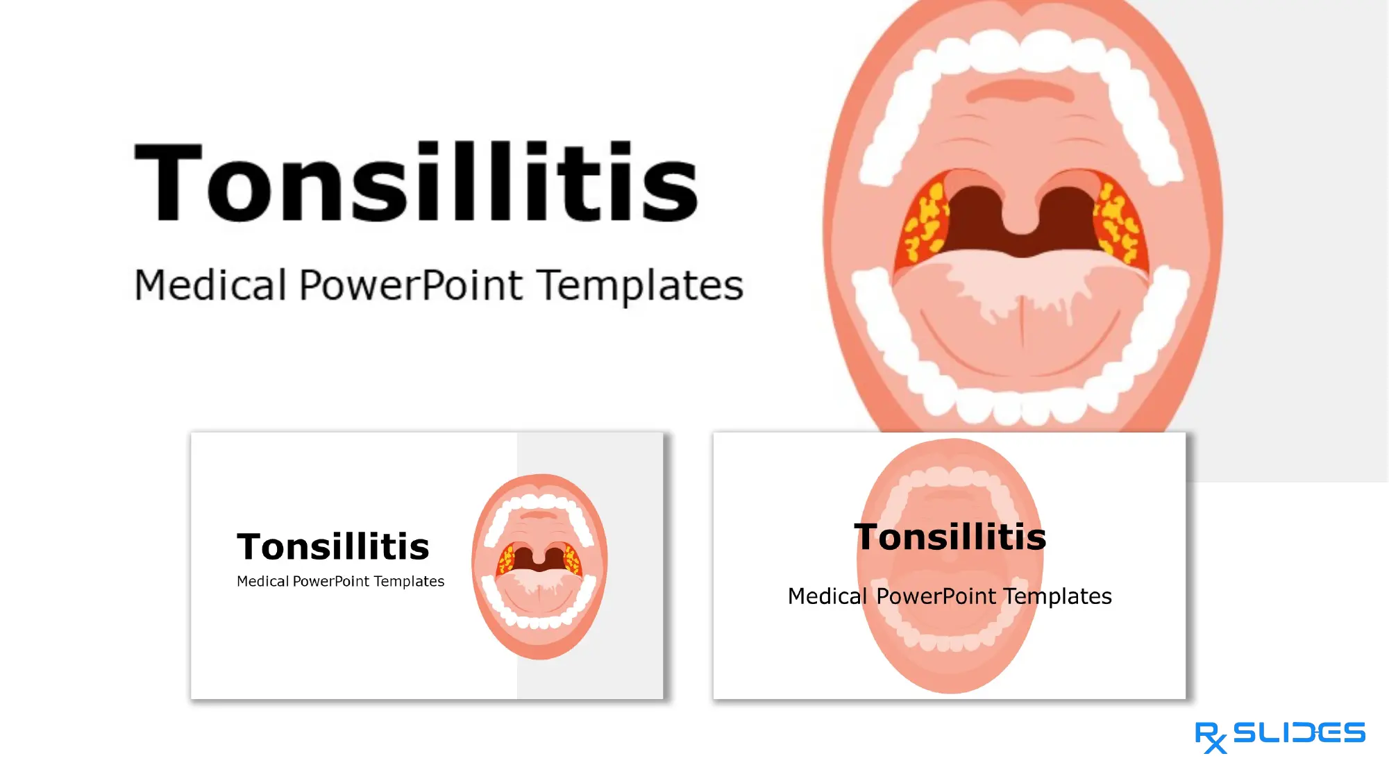Download Tonsillitis PowerPoint Template| RxSlides