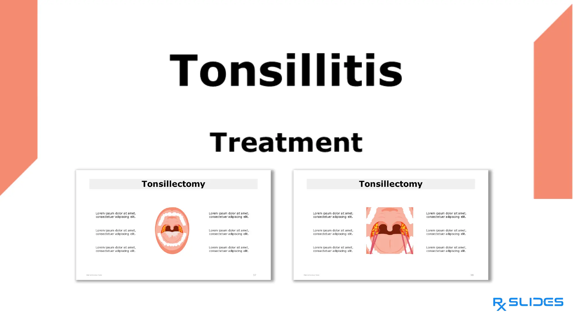 Download Tonsillitis PowerPoint Template| RxSlides