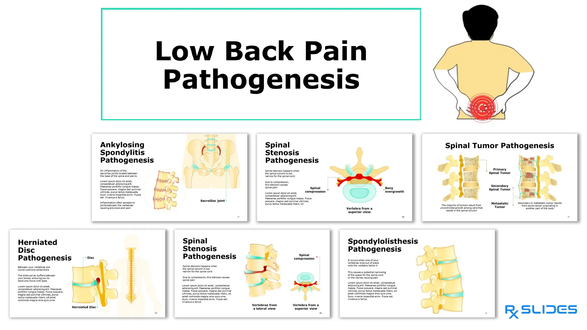 Download Low Back Pain PowerPoint Template|RxSlides