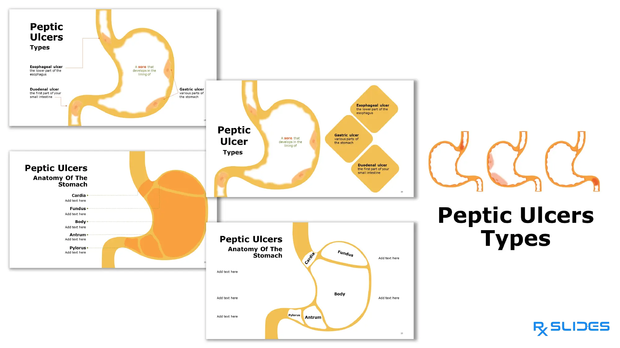 Download Peptic Ulcer Disease PowerPoint Template| RxSlides