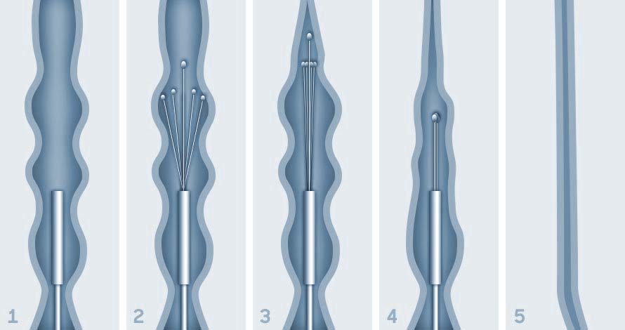 Dr Newmans Clinic | Vein Treatment | Radiofrequency Ablation