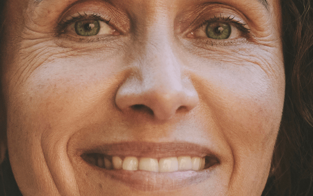 Dr Newmans Clinic | Nose Thread Veins | Nose Spider Veins