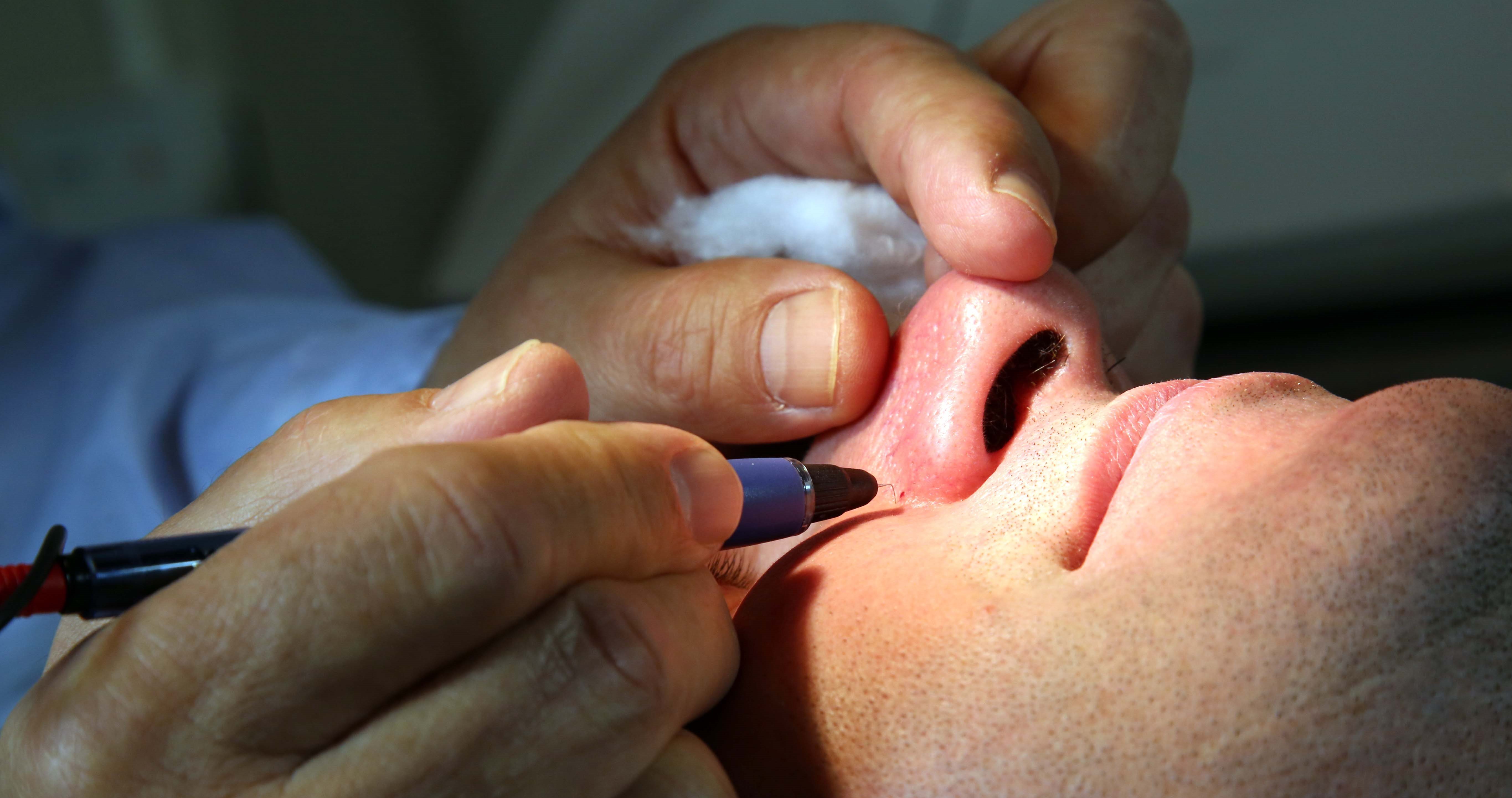 Dr Newmans Clinic | News | Thread Vein and Best Removal Treatments