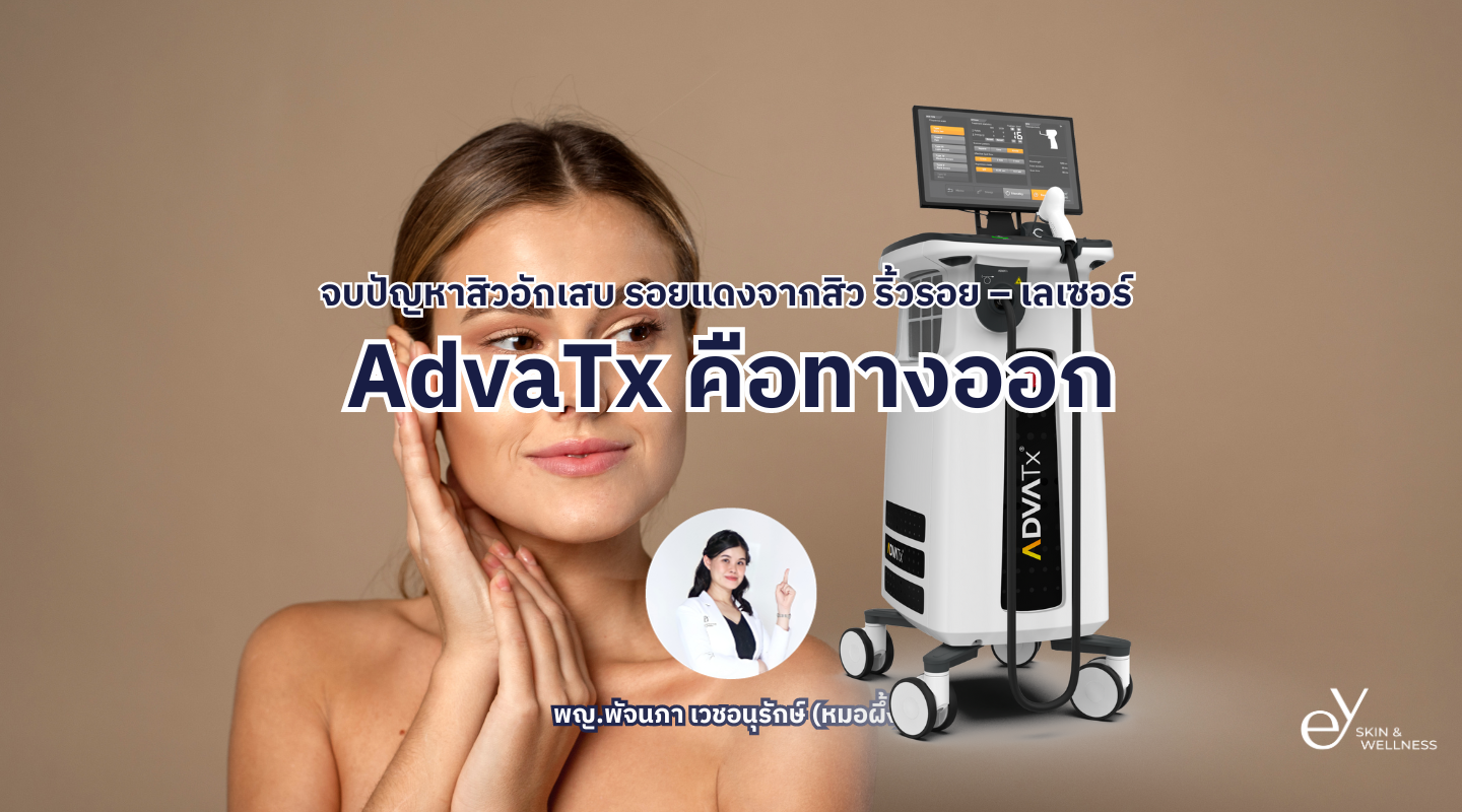 จบปัญหาสิวอักเสบ รอยแดงจากสิว ริ้วรอย – เลเซอร์ AdvaTx คือทางออก