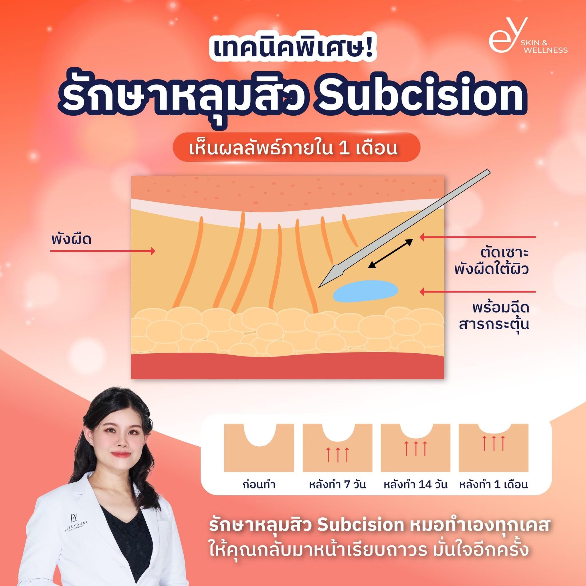 หลุมสิว เกิดจากอะไร รักษาเองได้ไหม รักษาด้วยวิธีไหนได้บ้าง