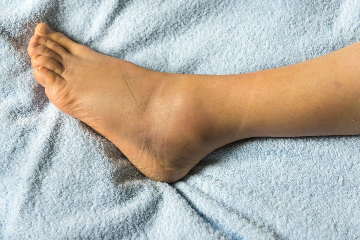 Broken Ankle vs Sprained Ankle: How to Tell the Difference and What to ...