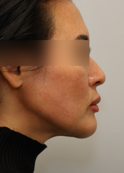 Chin & Jawline Contouring | Tribeca Aesthetics® in NYC