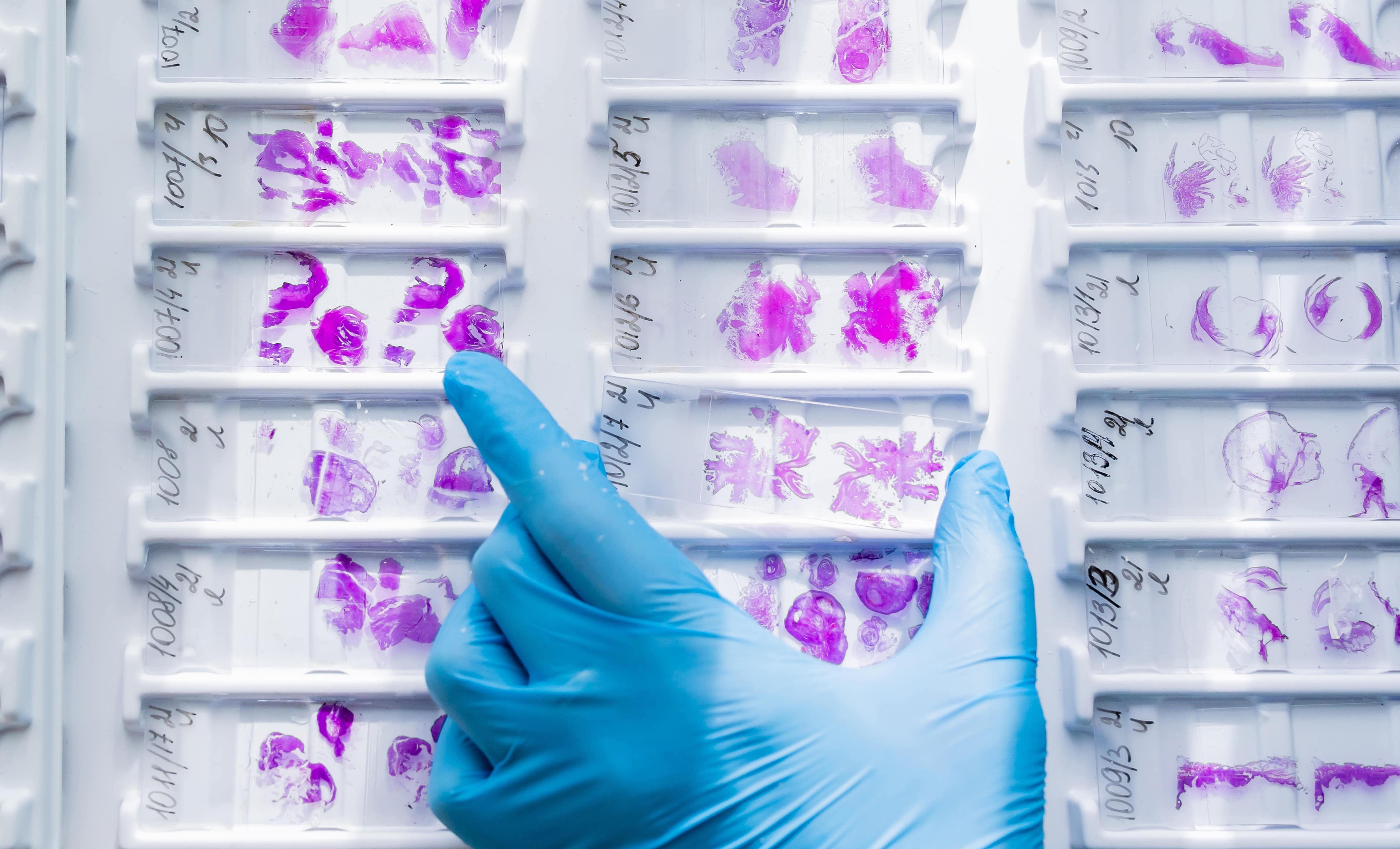 Owkin expands reach of AI diagnostic for colorectal cancer via ...