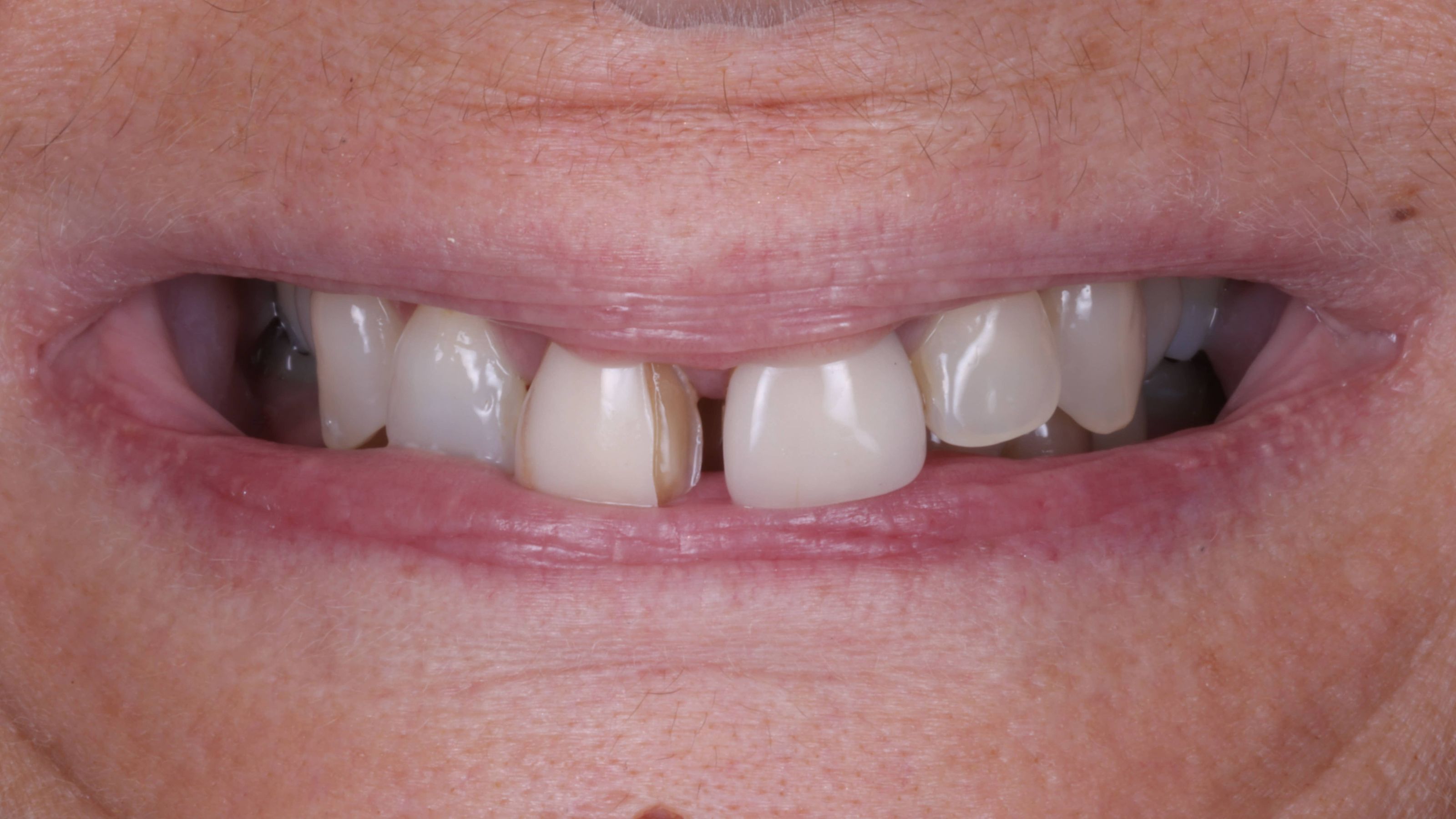 Veneers at Dale House Dental Practice