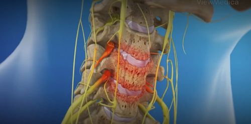 Anterior Cervical Corpectomy And Fusion Surgery in Dallas, TX