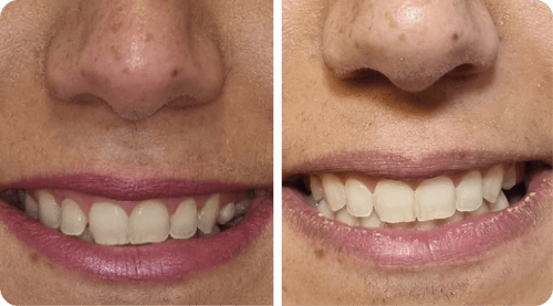 Straighten Your Smile with Clear Aligners | Eon Aligner