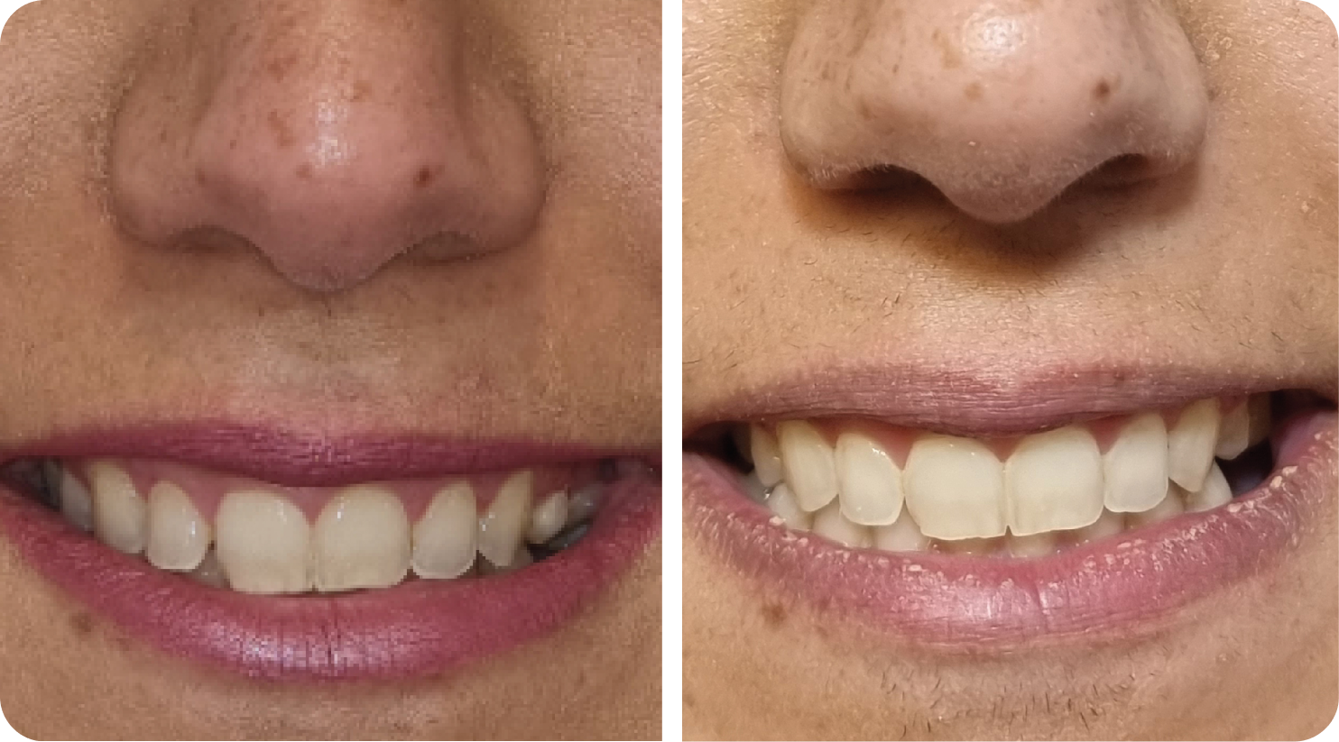 Straighten Your Smile with Clear Aligners | Eon Aligner