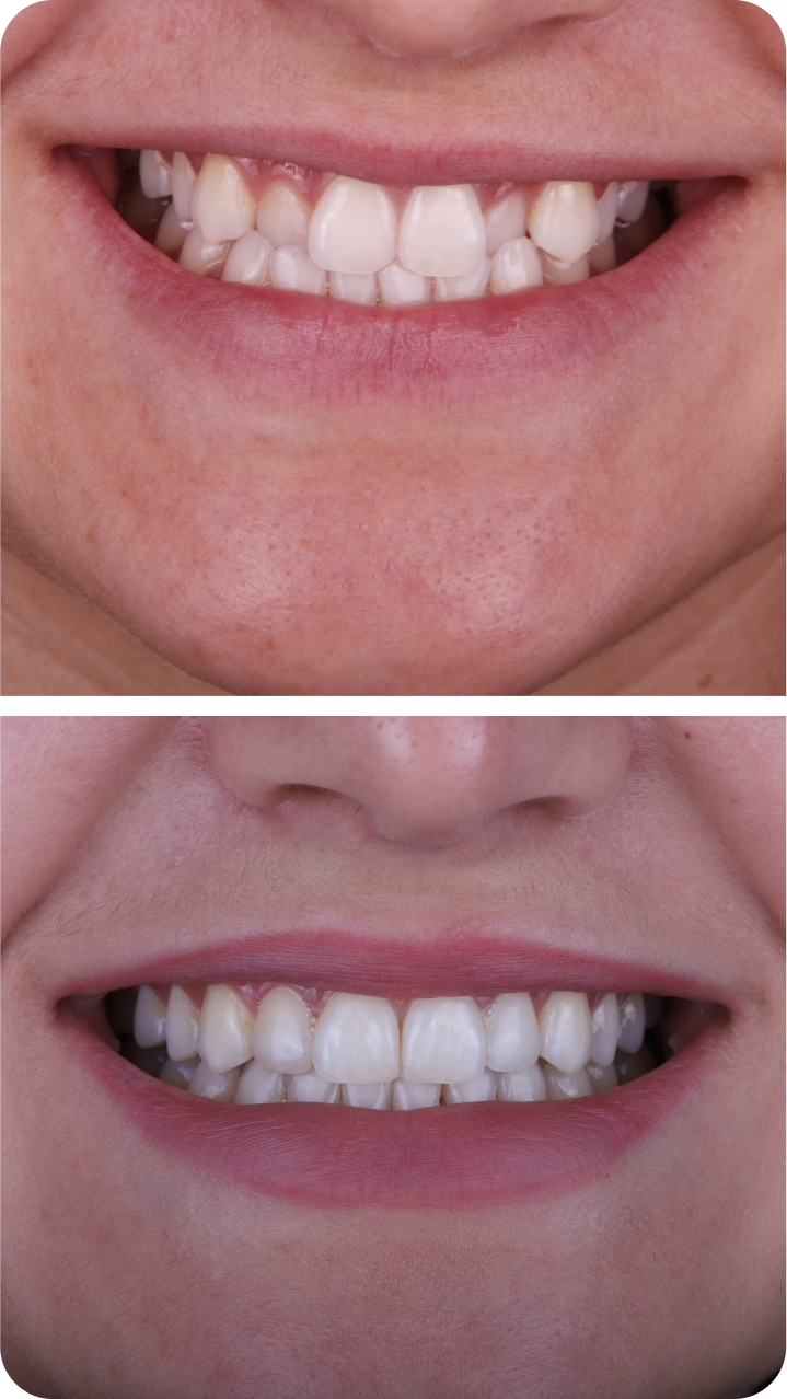 Straighten Your Smile with Clear Aligners | Eon Aligner