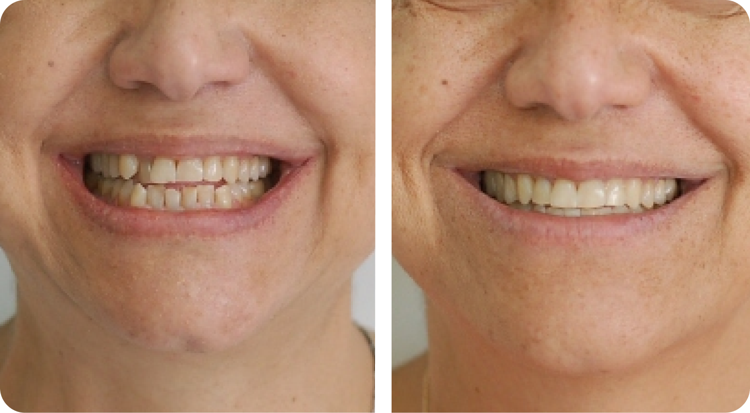 Straighten Your Smile with Clear Aligners | Eon Aligner