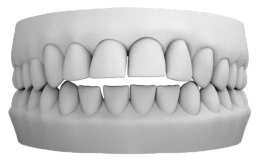 Straighten Your Smile with Clear Aligners | Eon Aligner