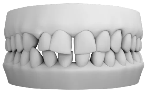 Straighten Your Smile with Clear Aligners | Eon Aligner
