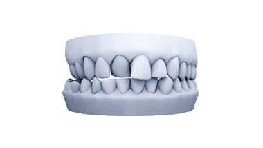 The Clear Way to Treat Your Crossbite| Eon Aligner