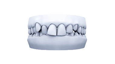 Clear Aligners: The Clear Way to Treat Your Deep Bite