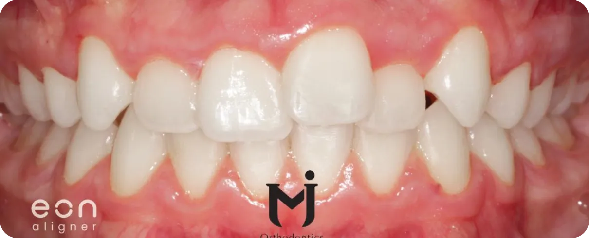 Become a Clear Aligner Provider | Aligner Solutions for Doctors | Eon ...