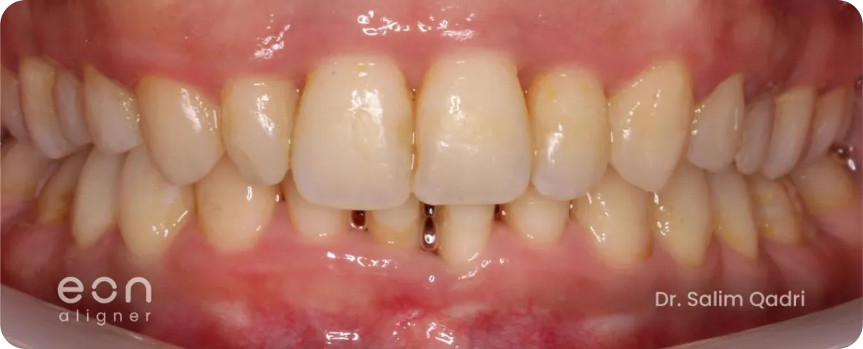 Become a Clear Aligner Provider | Aligner Solutions for Doctors | Eon ...