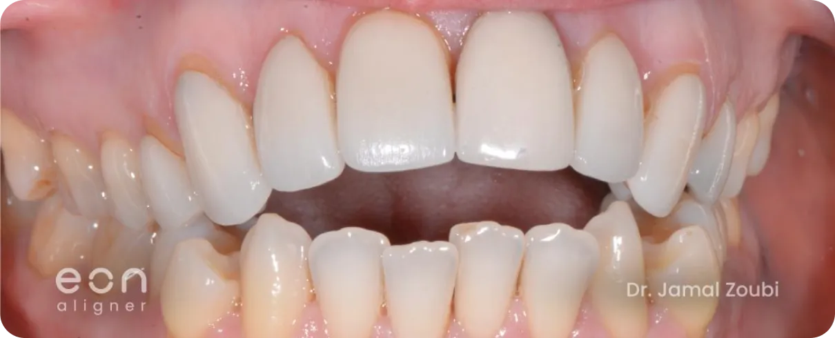 Become a Clear Aligner Provider | Aligner Solutions for Doctors | Eon ...