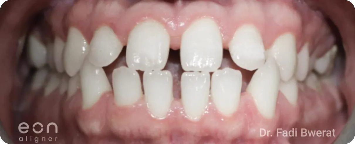 Become a Clear Aligner Provider | Aligner Solutions for Doctors | Eon ...