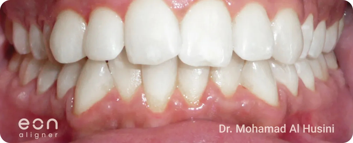 Become a Clear Aligner Provider | Aligner Solutions for Doctors | Eon ...