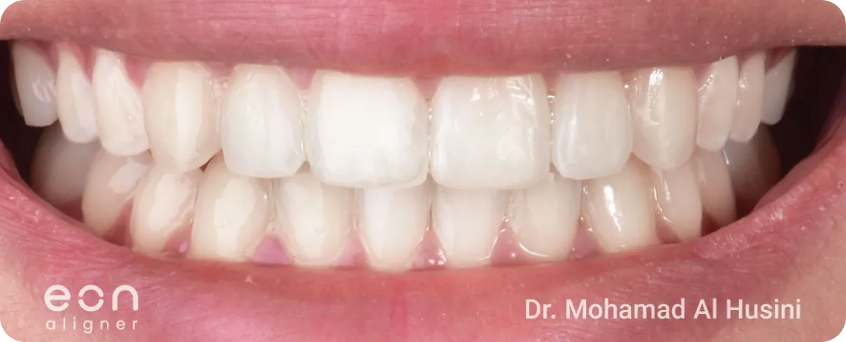 Become a Clear Aligner Provider | Aligner Solutions for Doctors | Eon ...