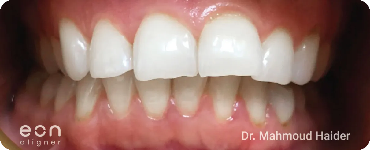 Become a Clear Aligner Provider | Aligner Solutions for Doctors | Eon ...