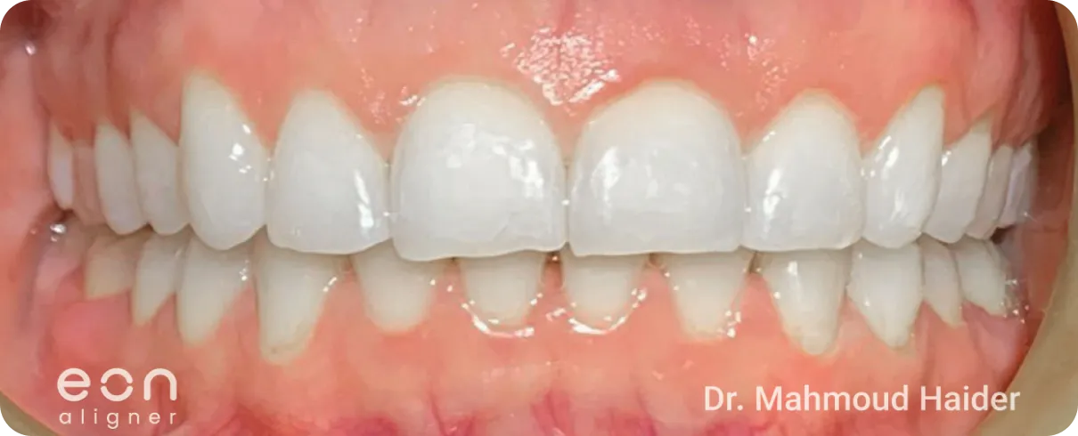 Become a Clear Aligner Provider | Aligner Solutions for Doctors | Eon ...