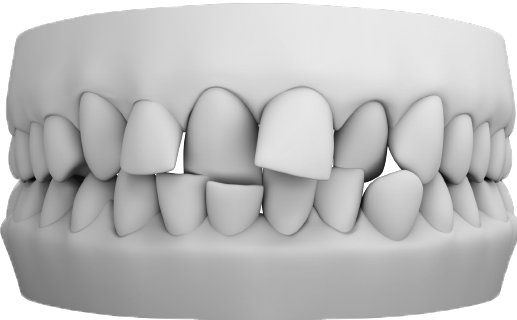 Straighten Your Smile with Clear Aligners | Eon Aligner