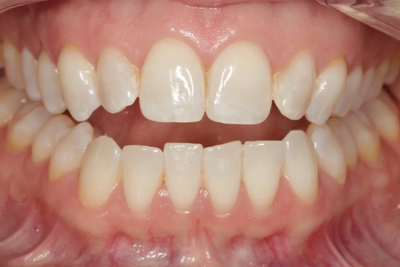 How to fix an open bite: Achieve a healthy smile! | Eon Aligner