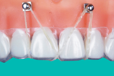 How to fix an open bite: Achieve a healthy smile! | Eon Aligner