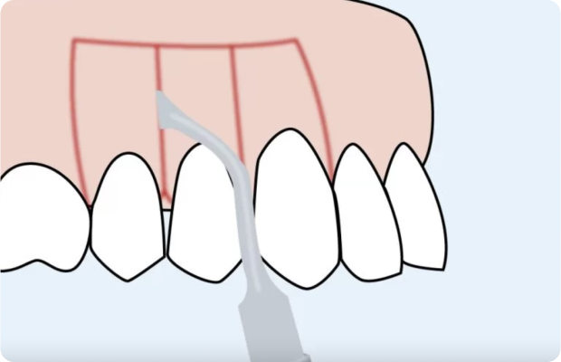Accelerated Orthodontics: A Faster Way to Straighten Teeth