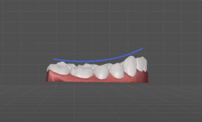 Deep Bite Correction with Aligners: Case Study Insights