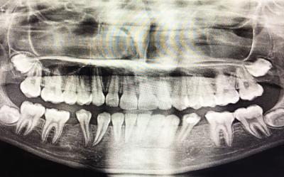 Deep Bite Correction with Aligners: Case Study Insights