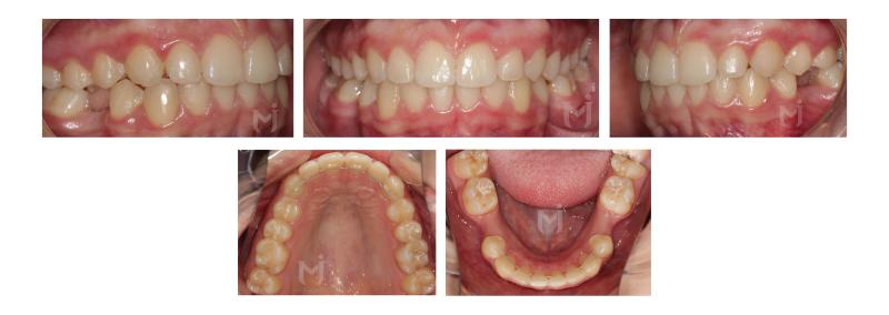 Deep Bite Correction with Aligners: Case Study Insights