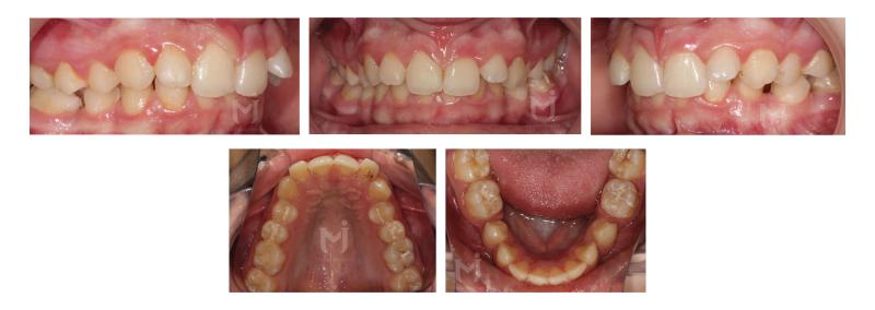 Deep Bite Correction with Aligners: Case Study Insights