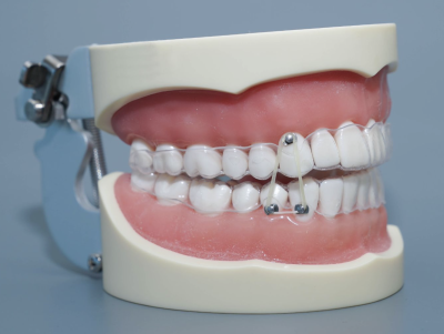 Intermaxillary Elastics with Clear Aligners: Types & Use