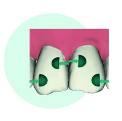 Biomechanics of Clear Aligners (Analysis of Acting Forces)