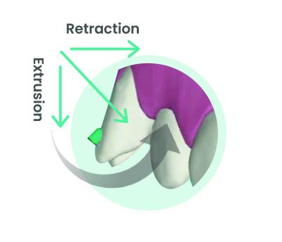 Biomechanics of Clear Aligners (Analysis of Acting Forces)
