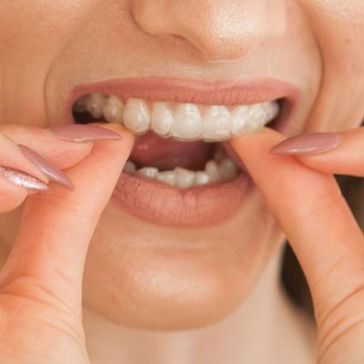 Clear Aligner Treatment Planning: A Guide to Dental Success