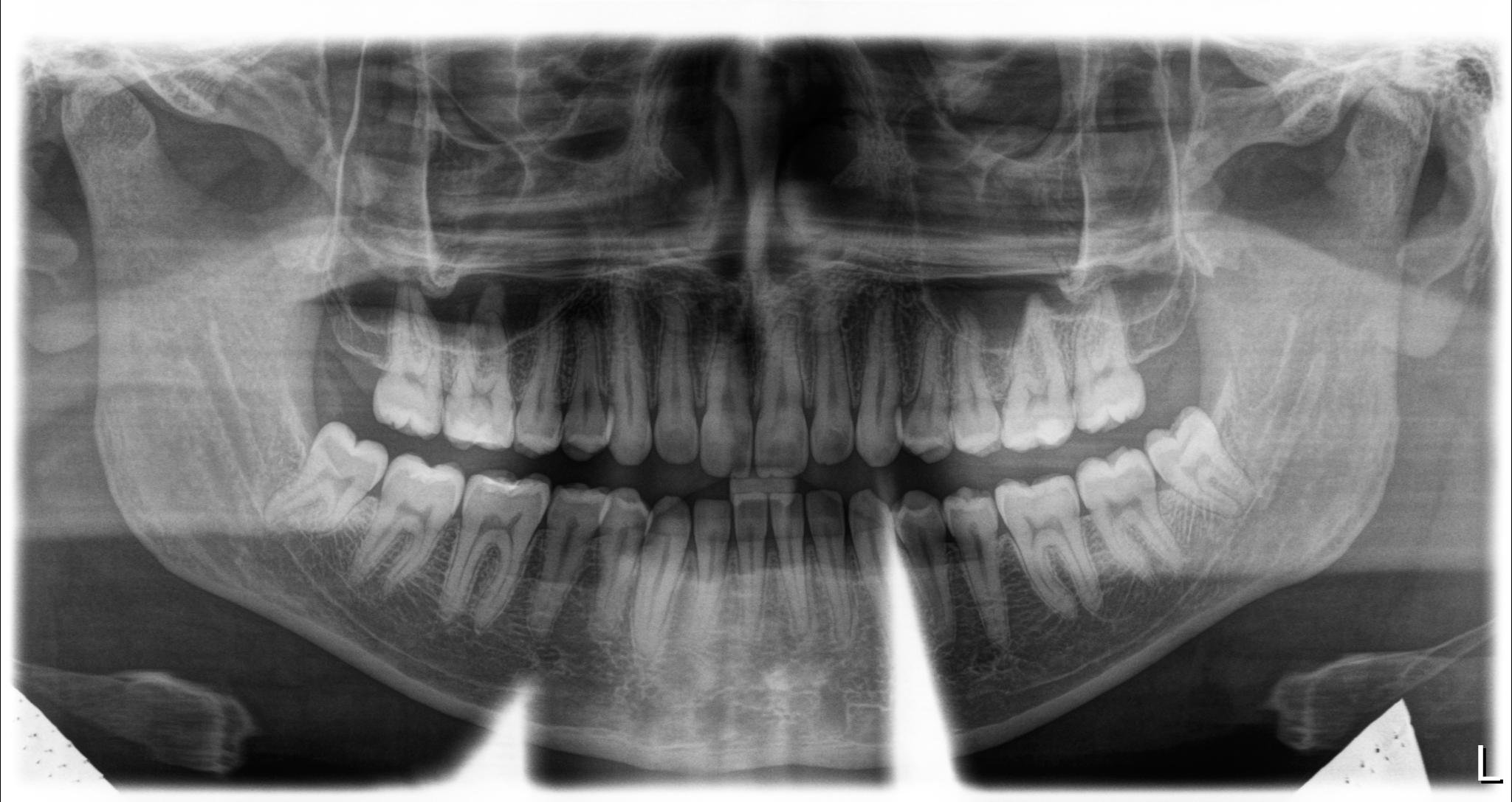 Class 3 Malocclusion Treatment With Clear Aligners (Treatment Plan ...