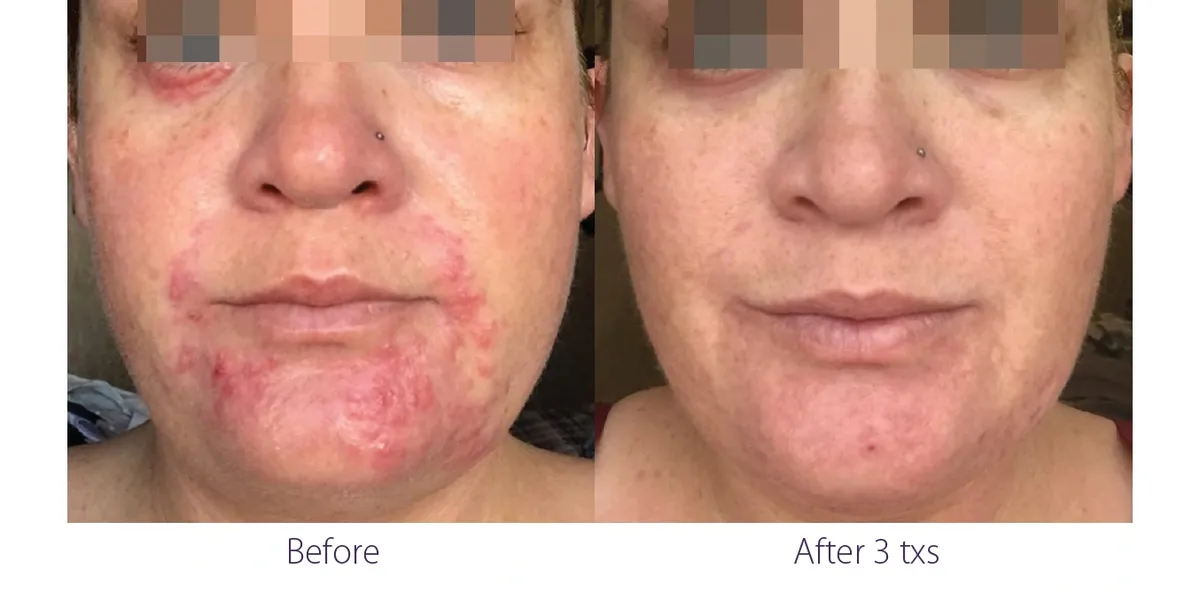 DYE VL for Vascular Lesions, Sun Damage, & Rosacea