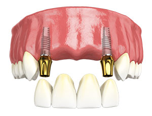 What Are Multi-Tooth Dental Implants? | HYBRIDGE®