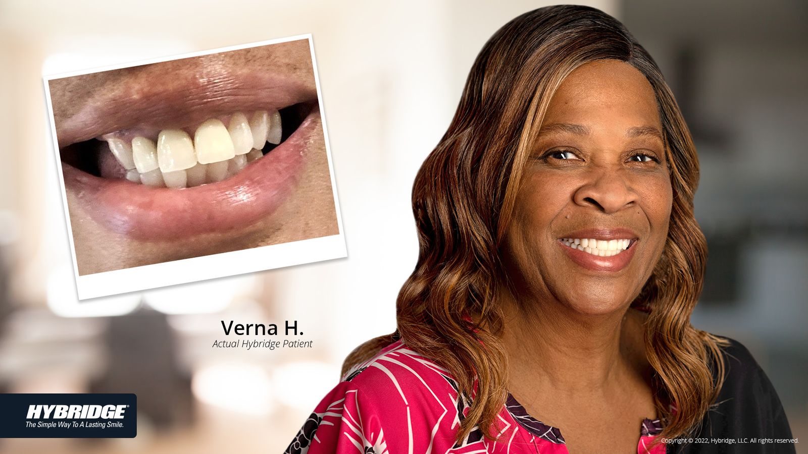 Hybridge Full Arch Smile Gallery