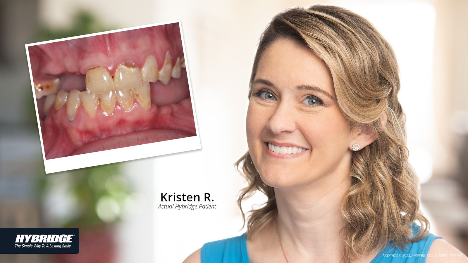 Hybridge Full Arch Smile Gallery